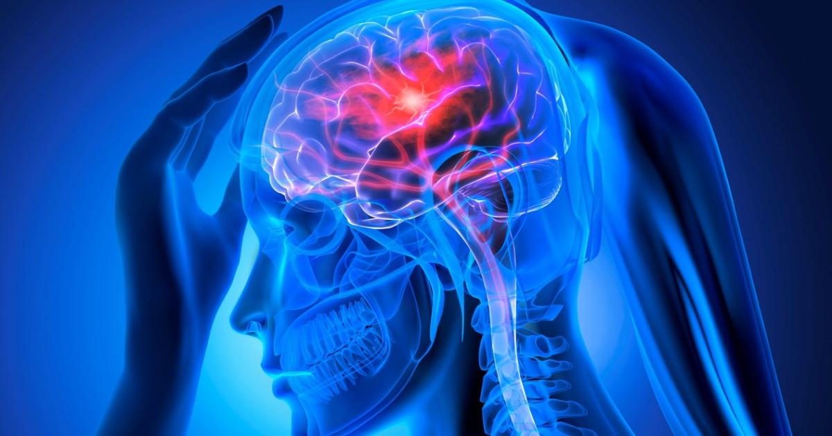 Kvinner kan ha andre symptomer på hjerneslag enn menn